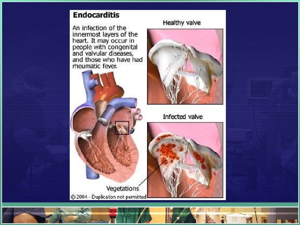 Rheumatic Heart Disease rheumatic-heart-disease