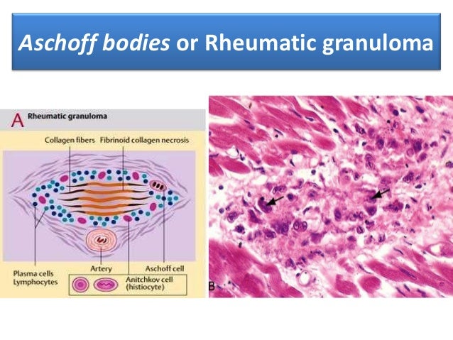 Rheumatic heart disease