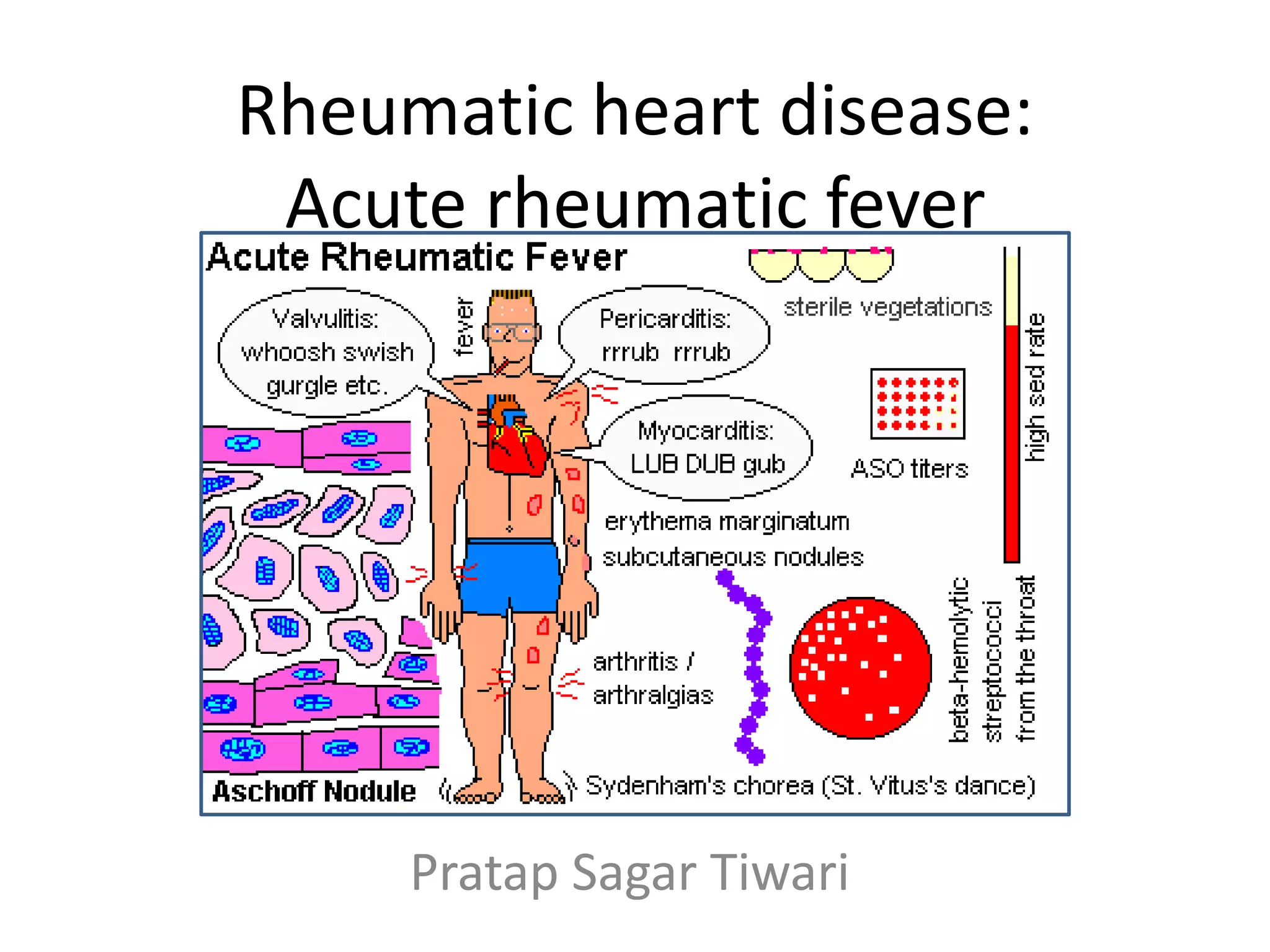 Rheumatic heart disease: Acute Rheumatic Fever | PPTX