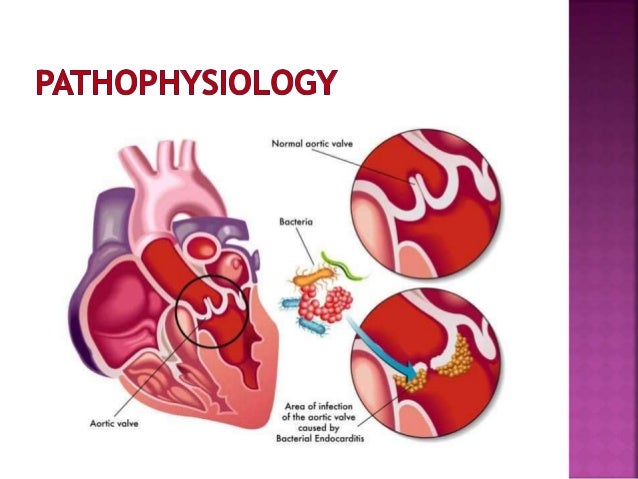Rheumatic heart disease