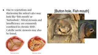 Rheumatic Heart Disease | PPTX