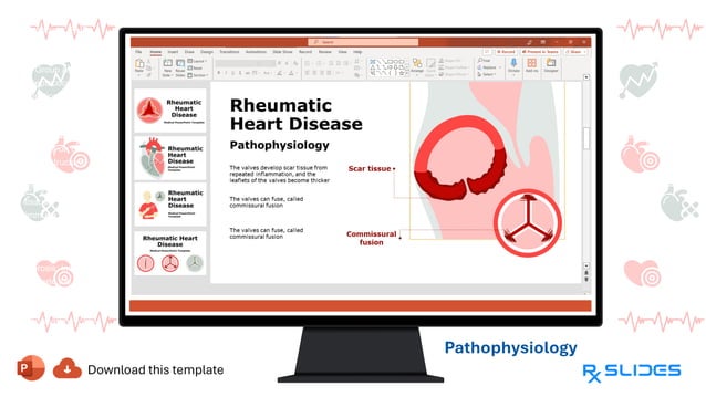 Rheumatic Heart Disease ( RHD ) | PDF | Heart and Cardiovascular ...