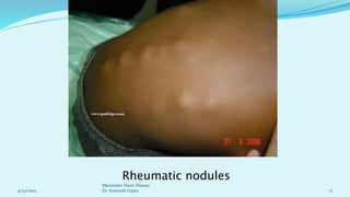 Rheumatic Heart Disease | PDF
