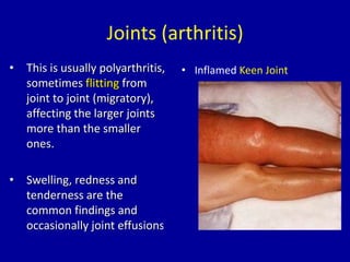 Rheumatic Heart Disease 2021.ppt