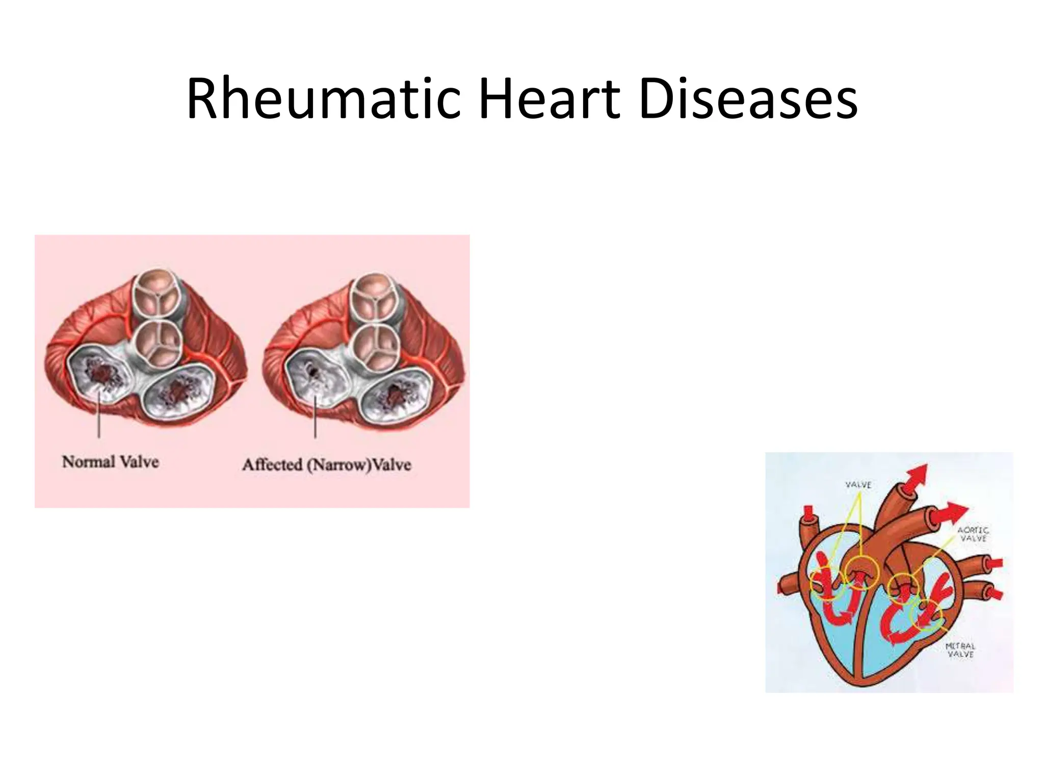 Rheumatic Heart Disease Brief Community Medicine | PPTX
