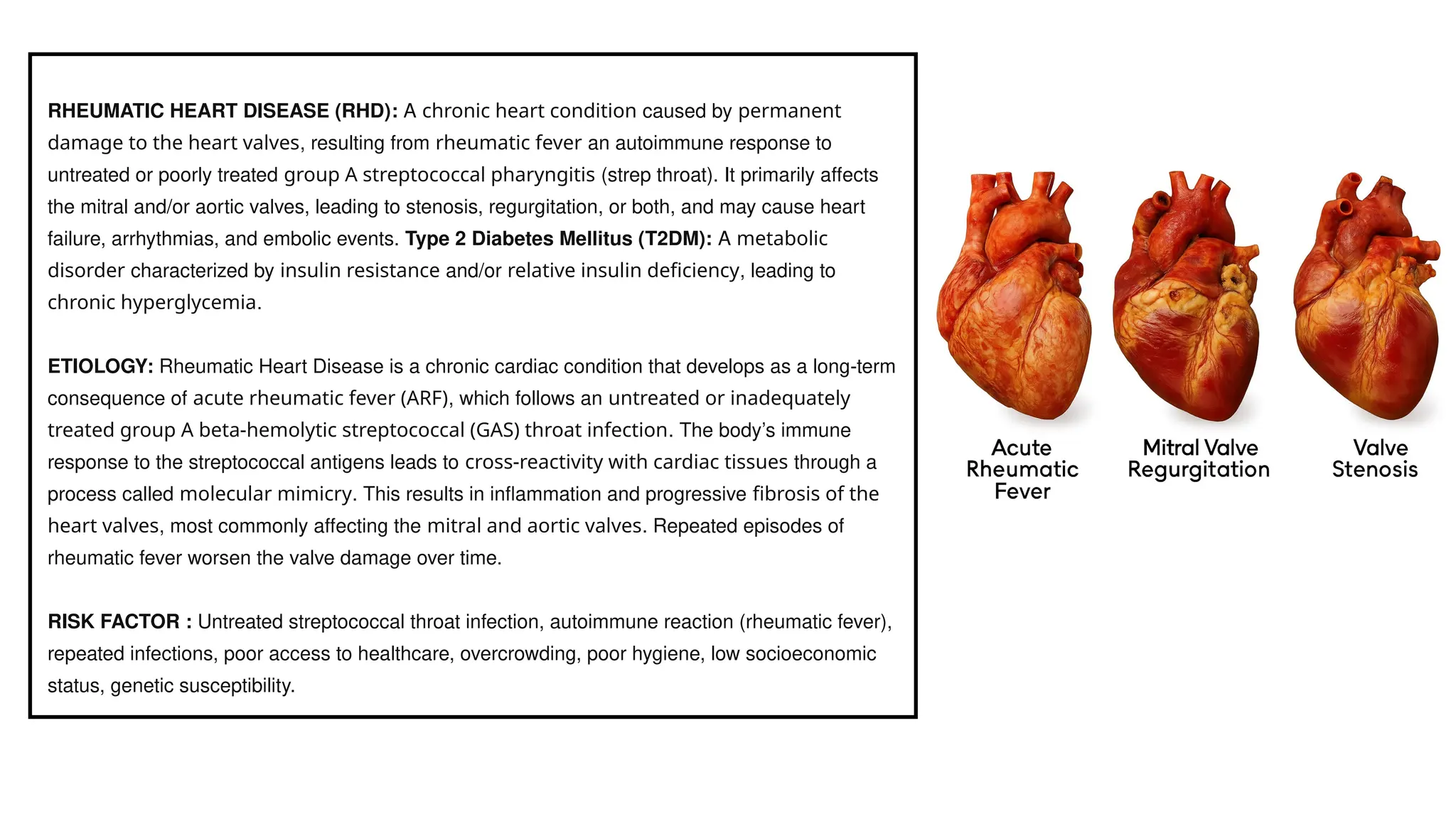 Rheumatic heart diseases with Type 2 Diabetes Mellitus | PPTX
