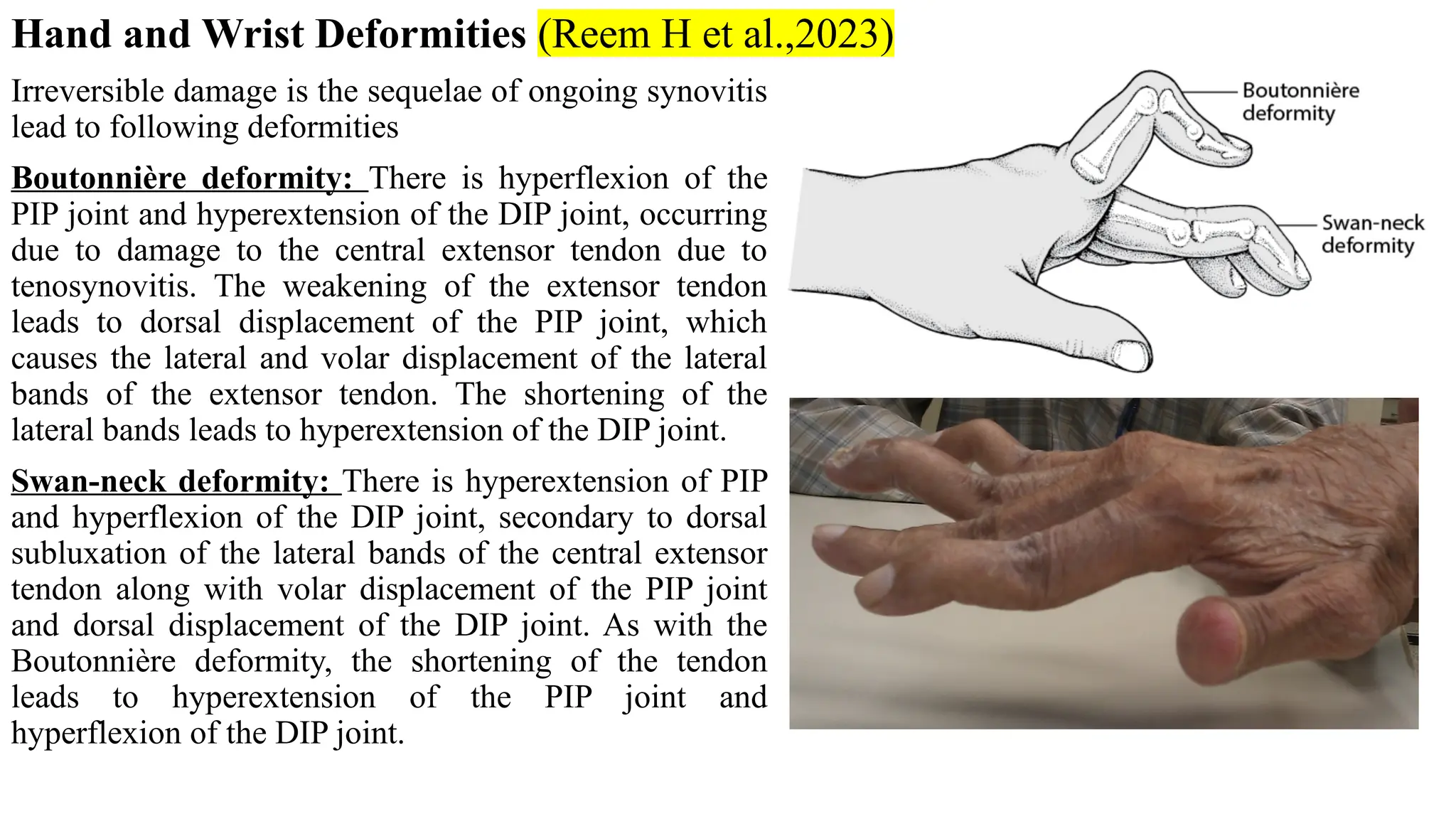 RHEUMATOID ARTHRITIS OF EXTRIMETIES AND SPINE .pptx