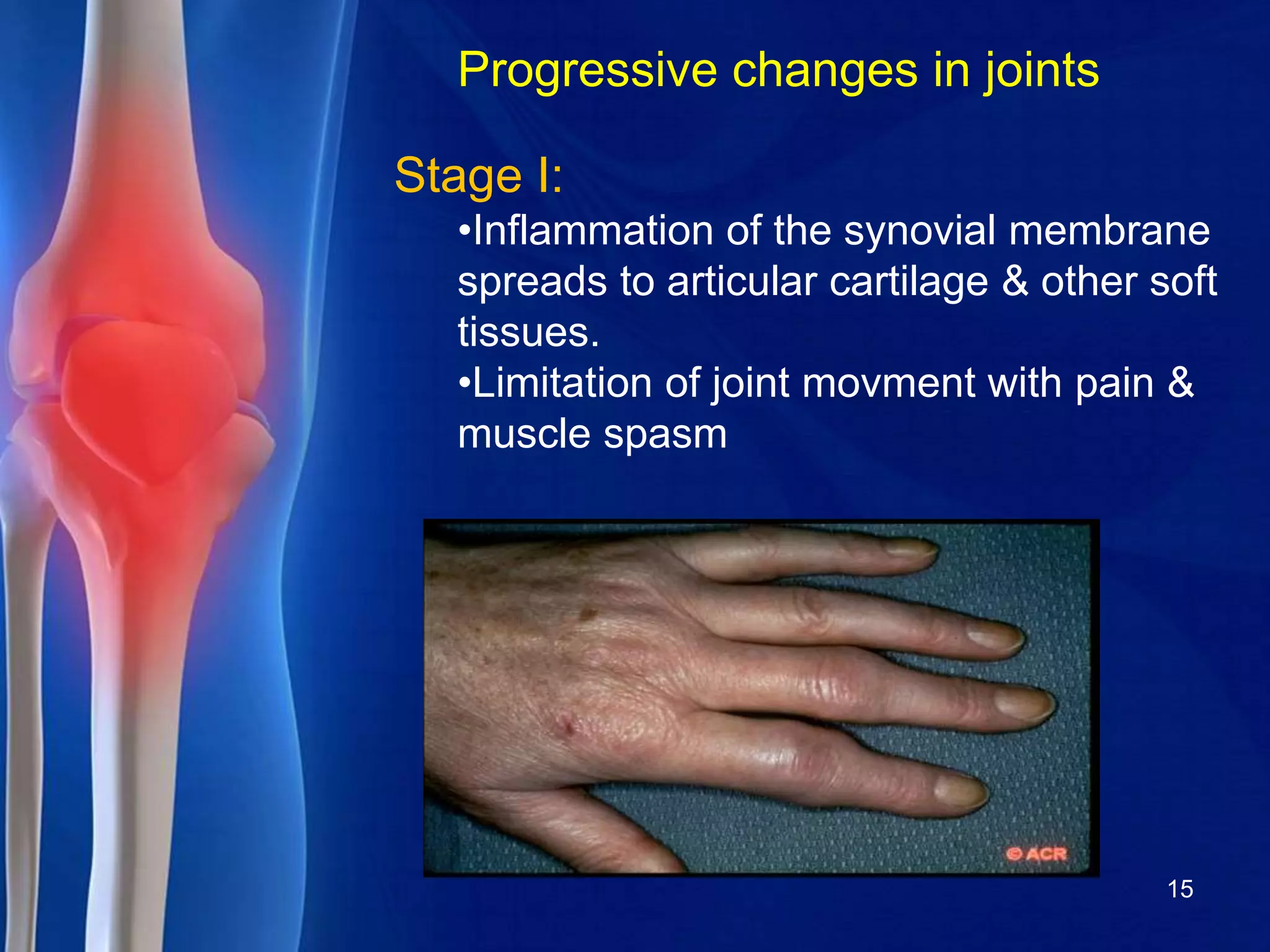 rheumatoid arthritis | PPTX