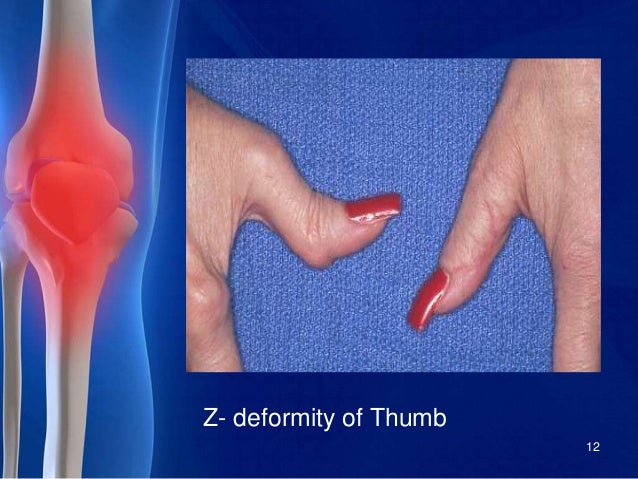 rheumatoid arthritis