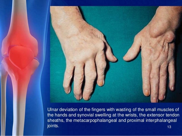 rheumatoid arthritis