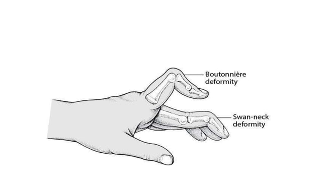 Deformities in rheumatoid arthriris.pptx