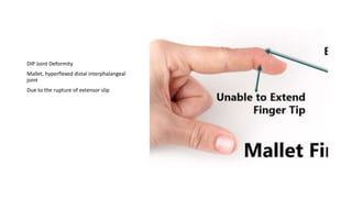 Deformities in rheumatoid arthriris.pptx