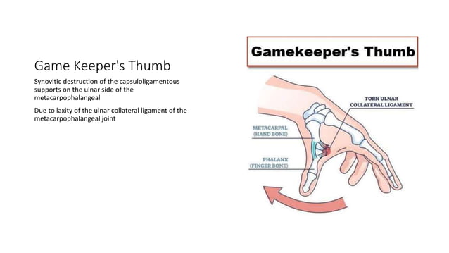 Deformities in rheumatoid arthriris.pptx