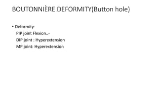 Deformities in rheumatoid arthriris.pptx