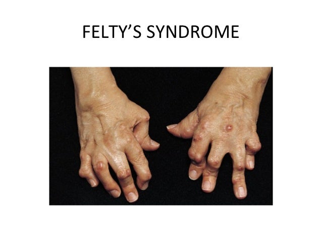 Rheumatoid arthritis