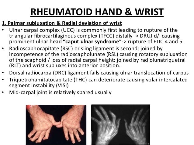 Rheumatoid arthritis for undergraduates