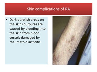 Rheumatoid arthritis | PPTX