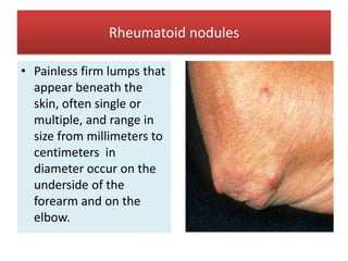 Rheumatoid Arthritis Elbow Nodules