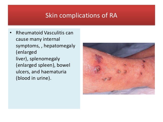 Rheumatoid arthritis