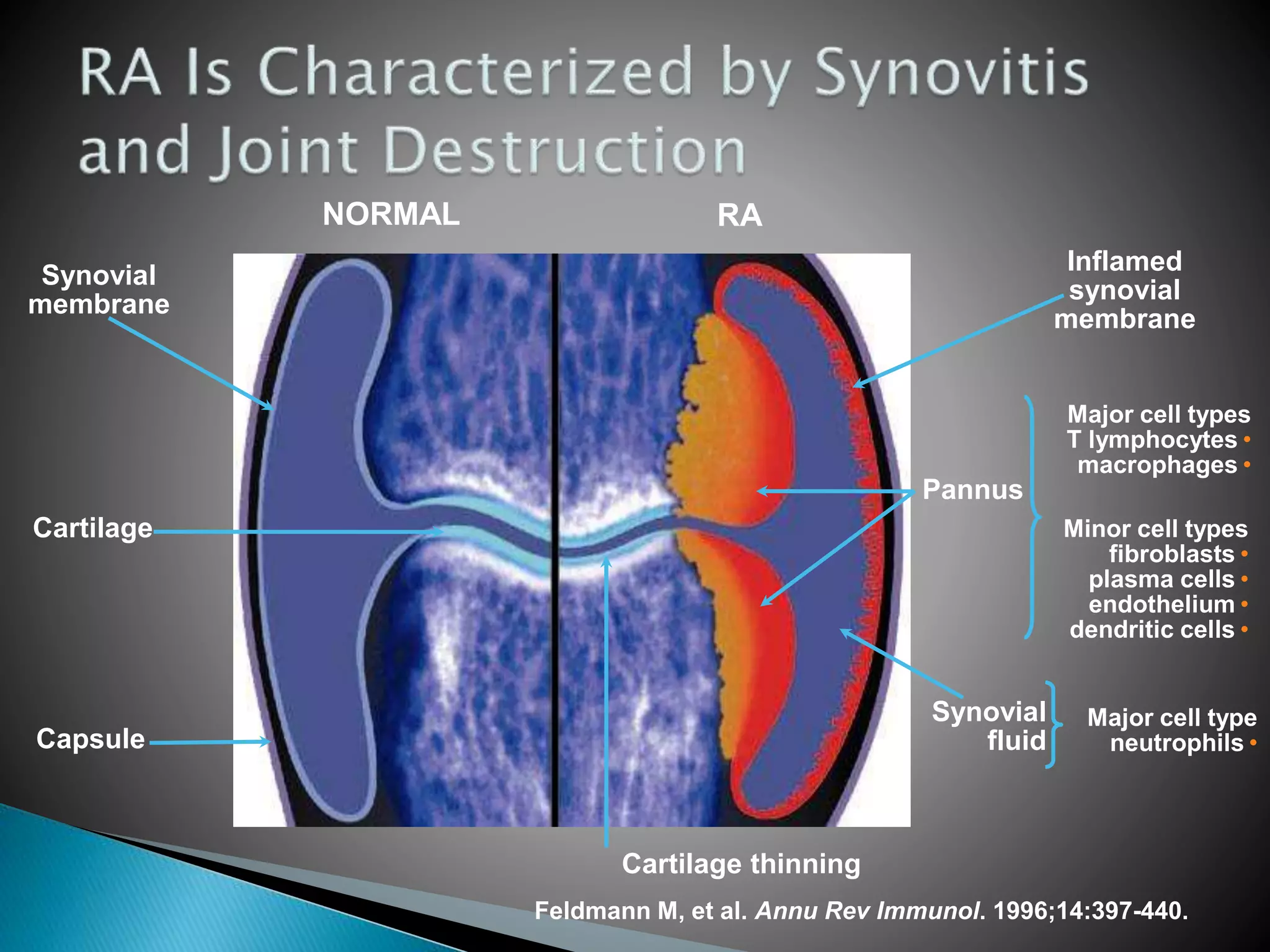 Rheumatoid arthritis | PPTX