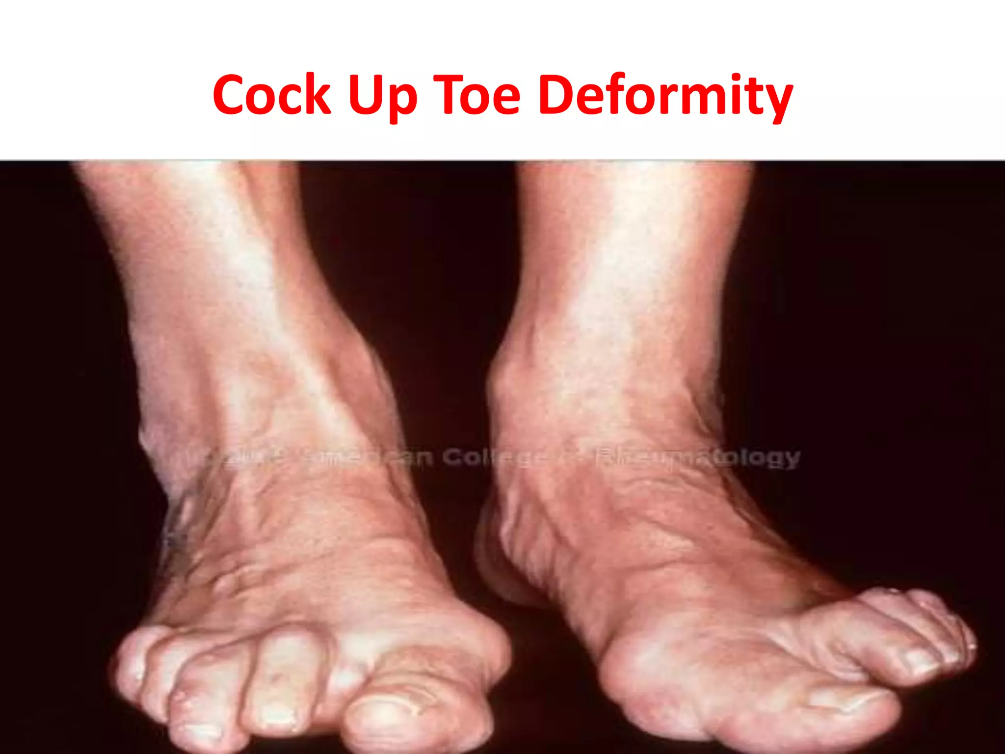 Rheumatoid arthritis | PPTX