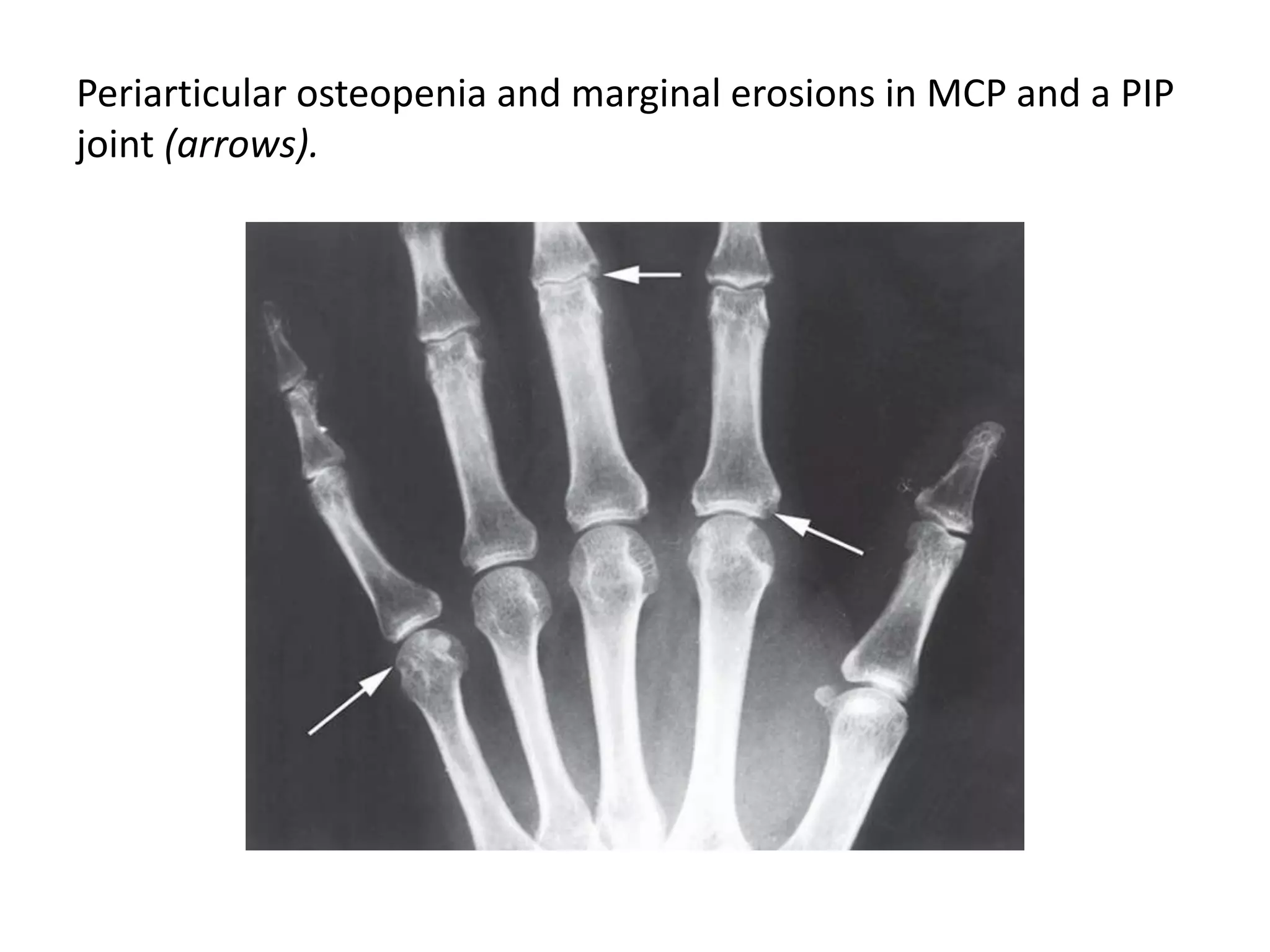 Rheumatoid arthritis | PPTX