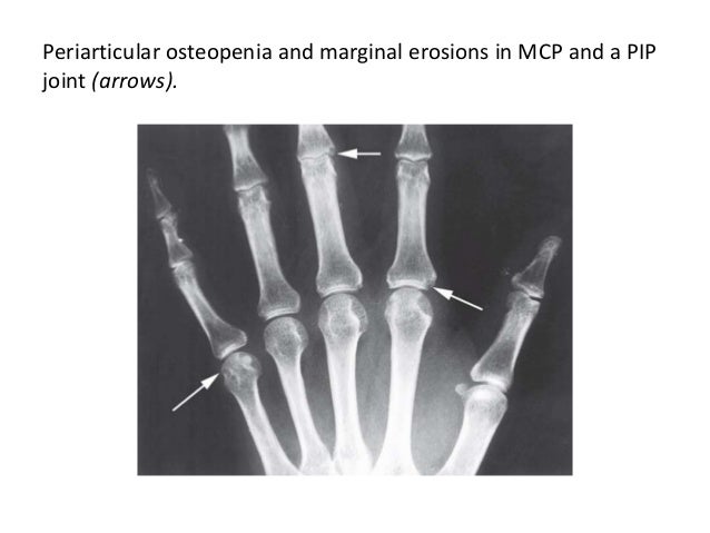 Rheumatoid arthritis