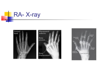 Rheumatoid arthritis | PPT