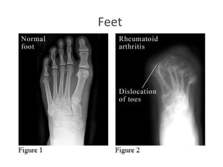 Rheumatoid arthritis | PPT