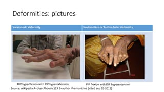 Rheumatoid arthritis | PPTX