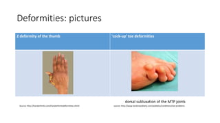 Rheumatoid arthritis | PPTX