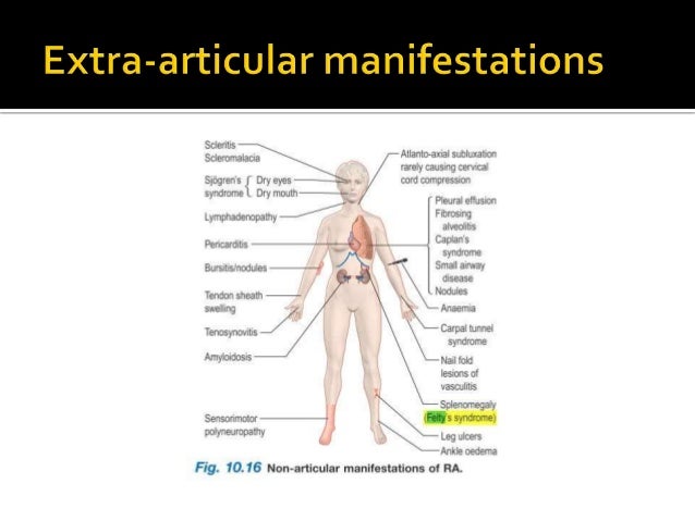 Rheumatoid arthritis