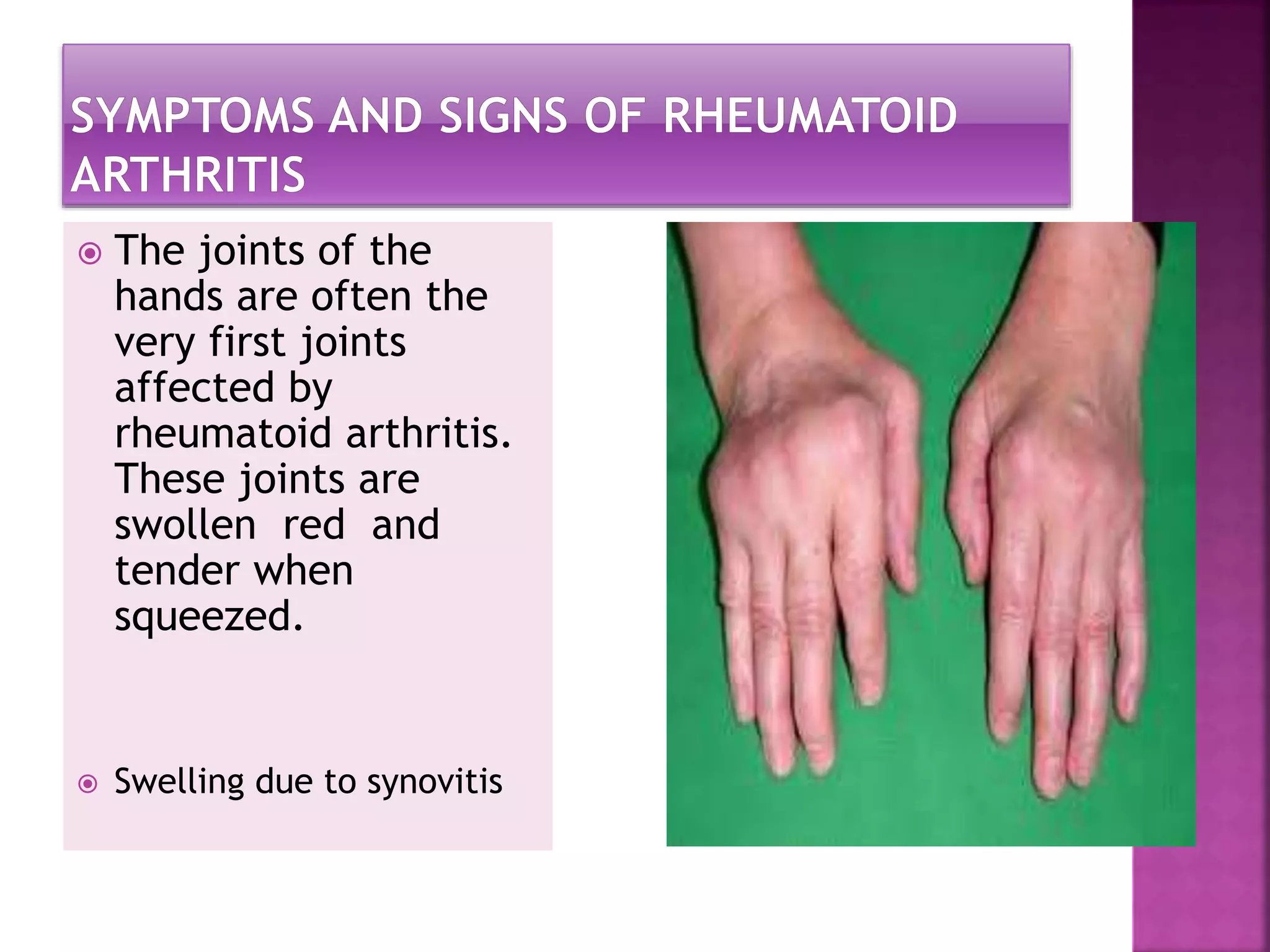 Rheumatoid arthritis | PPTX