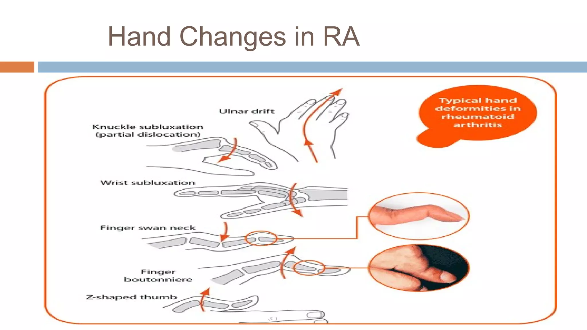 Pharmacotherapy of Rheumatoid arthritis | PPT
