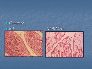 Rheumatoid arthritis | PPT