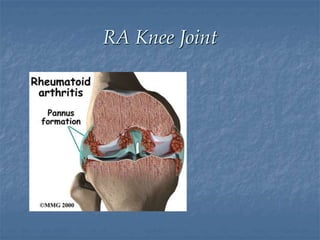 Rheumatoid arthritis | PPT