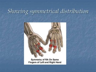 Rheumatoid arthritis | PPT