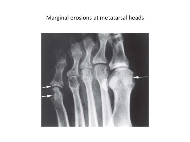 Rheumatoid arthritis