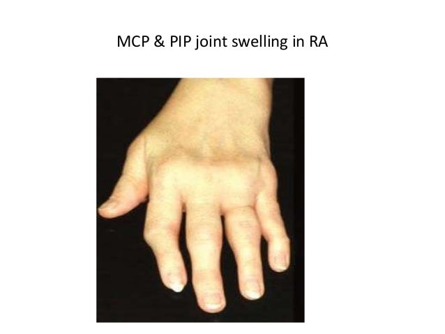 Rheumatoid arthritis