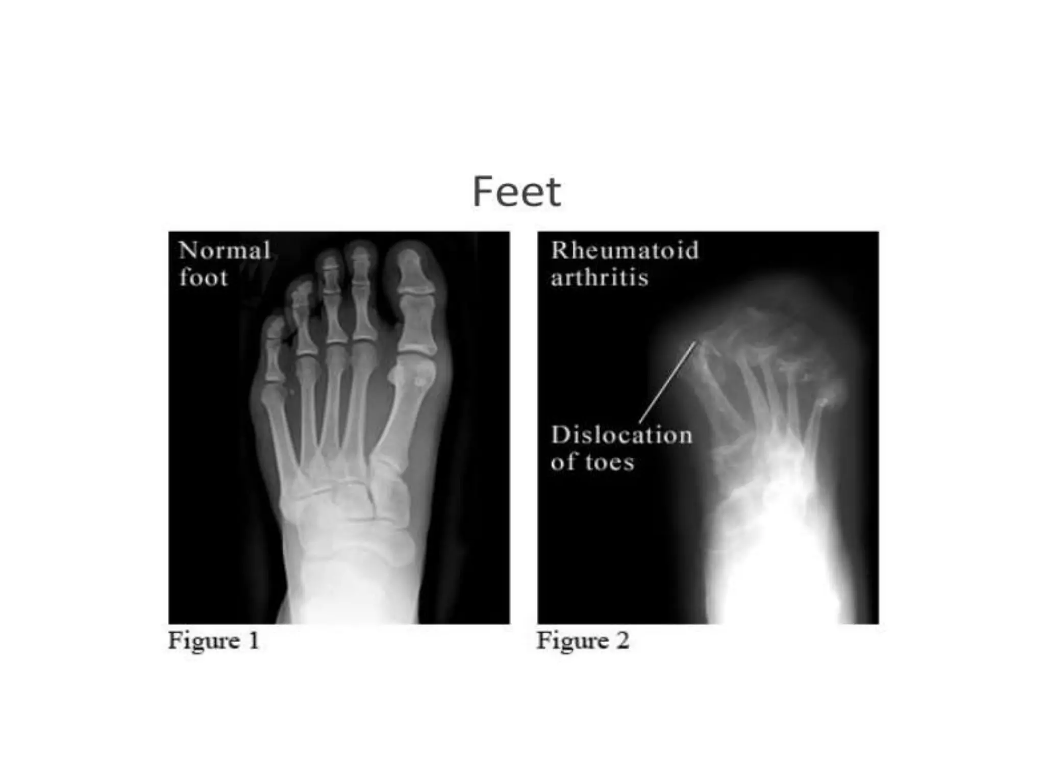 Rheumatoid arthritis | PPT
