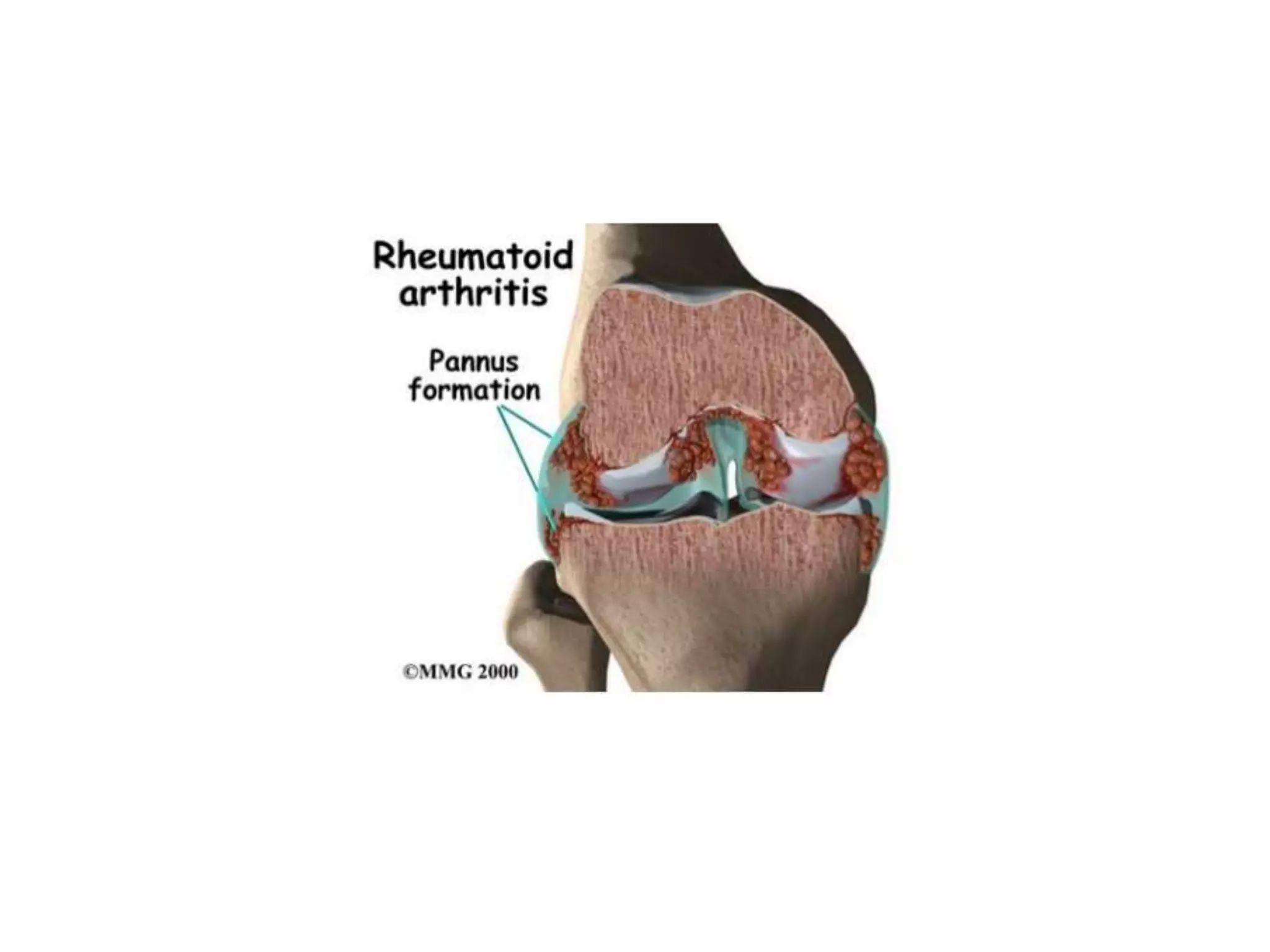 Rheumatoid arthritis | PPT