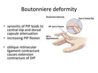 Rheumatoid arthritis | PPTX