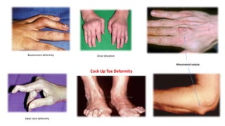 Rheumatoid arthritis | PDF