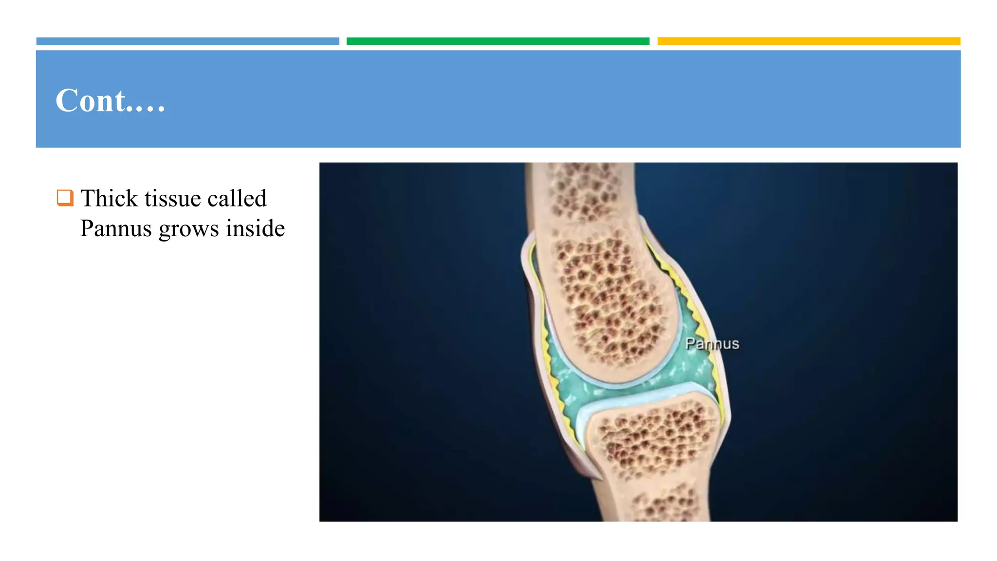 Rheumatoid Arthritis - Muhammad Tahir Habib | PPTX