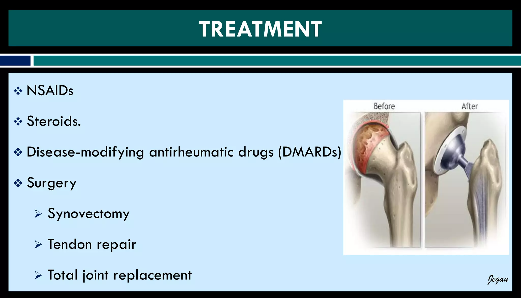 Pathophysiology of Rheumatoid arthritis | PDF