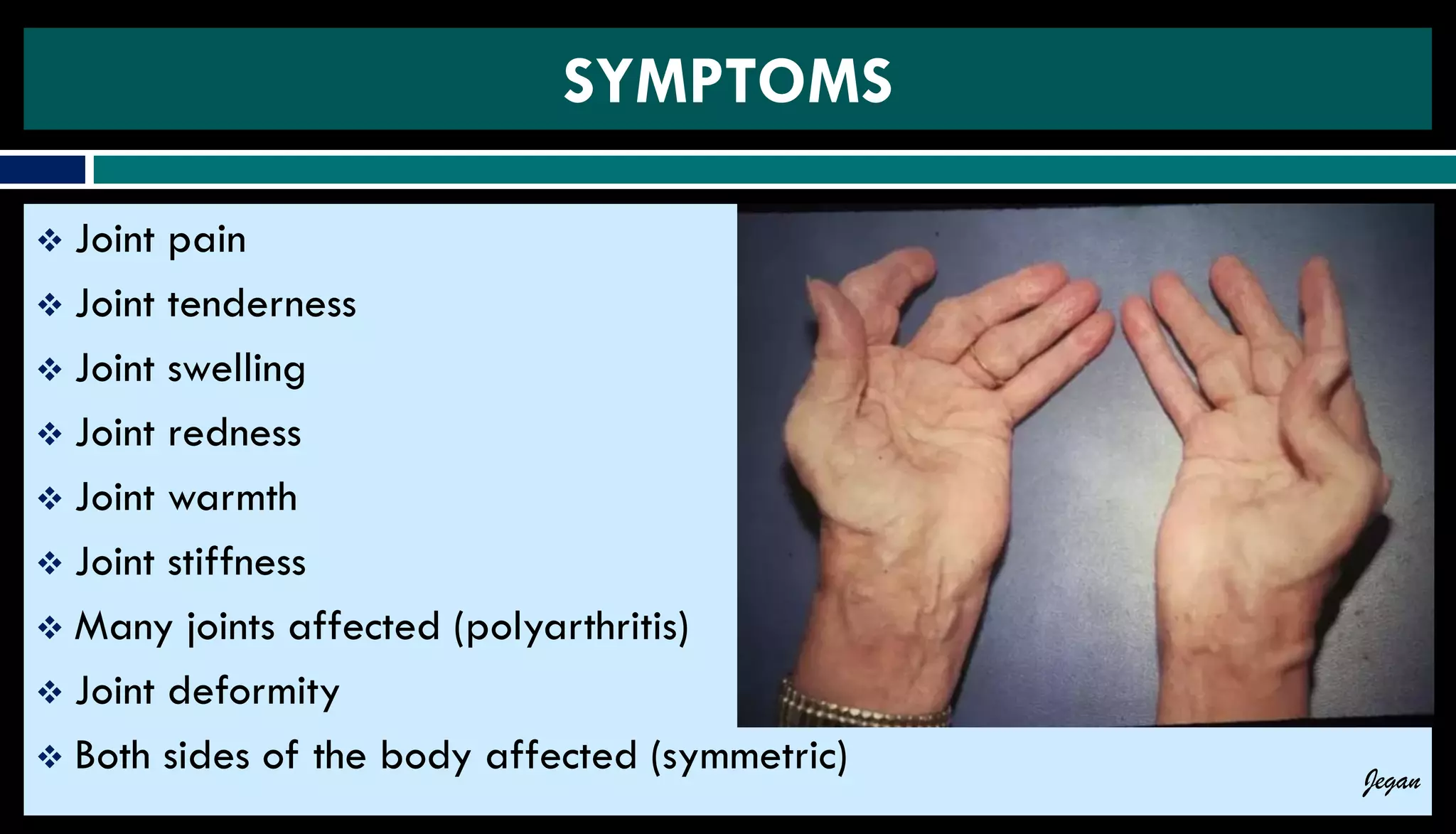 Pathophysiology of Rheumatoid arthritis | PDF