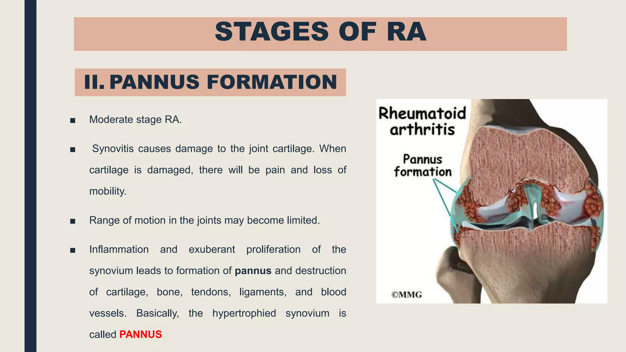 Rheumatoid arthritis | PPTX