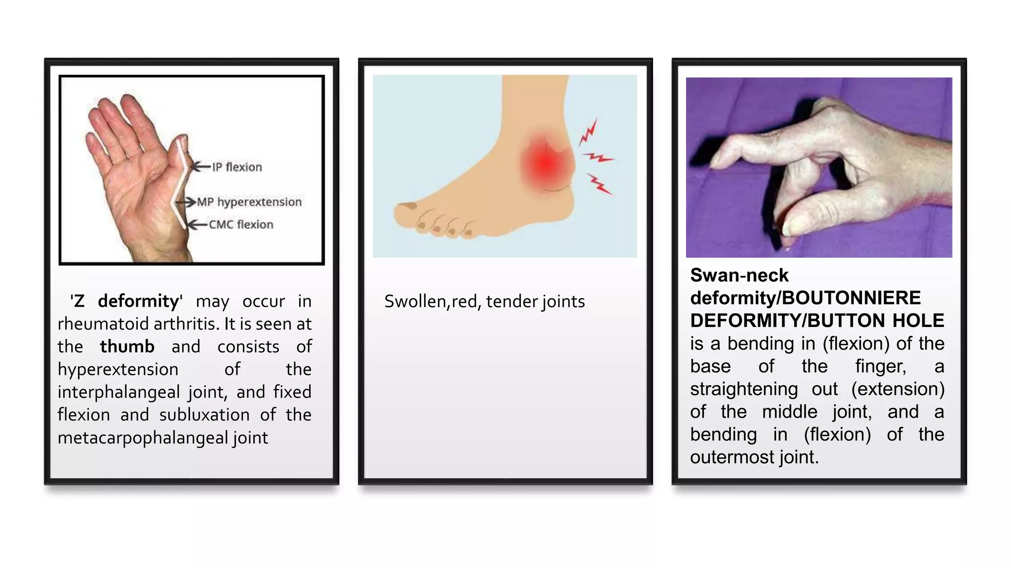 Rheumatoid arthritis | PPTX