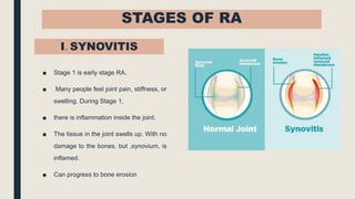 Rheumatoid arthritis | PPTX