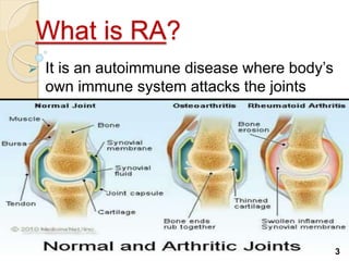 Rheumatoid arthritis | PPTX